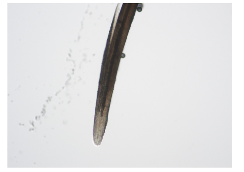 Creeping Hair: A Nice Case of Cutaneous Pili Migrans in a 19 month Old ...