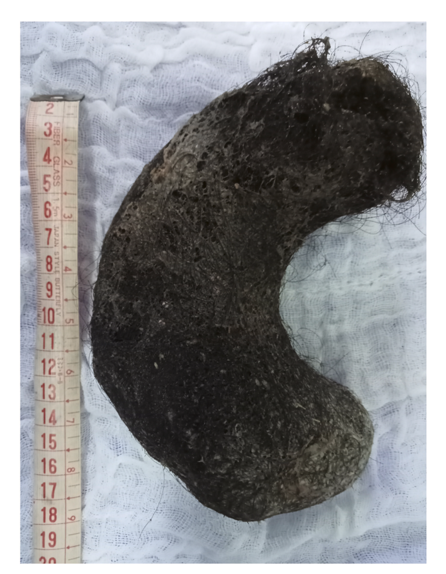 Gastric Trichobezoar: A complication of Trichotillomania — Donovan Hair ...