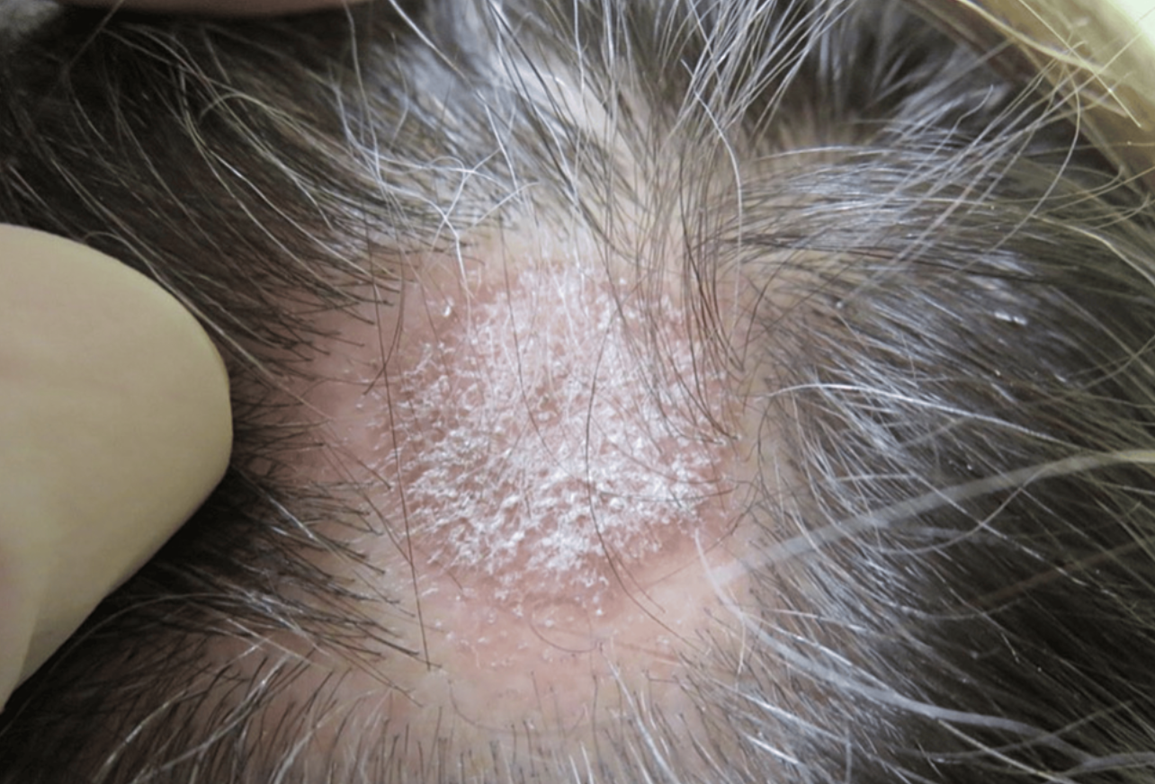 Dr. Donovan's Hair Loss Articles (2011-2024) — Donovan Hair Clinic