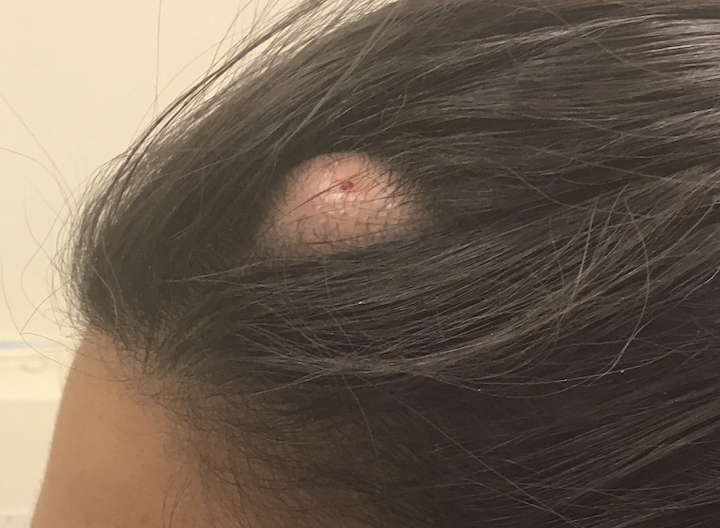 Pilar Cysts: What are my options? — Donovan Hair Clinic