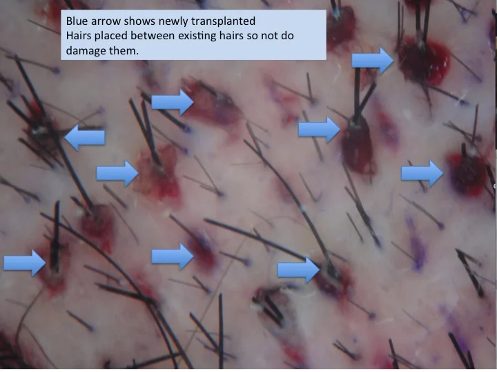 Hair Loss in Women: Often More than a Single Cause! — Donovan Hair Clinic