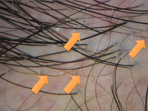 Hair Loss in Women: Often More than a Single Cause! — Donovan Hair Clinic
