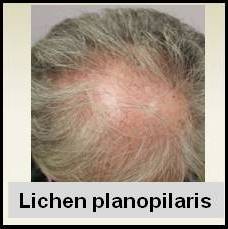Pioglitazone for Treatment of Lichen Planopilaris: New study of 24 ...