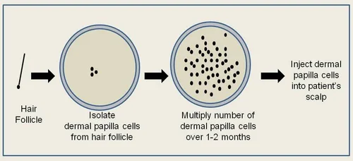 "Hair Cloning": Who? What? When? Where? and How? — Donovan Hair Clinic