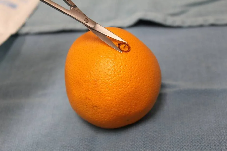 How is a Scalp Biopsy Performed? — Donovan Hair Clinic