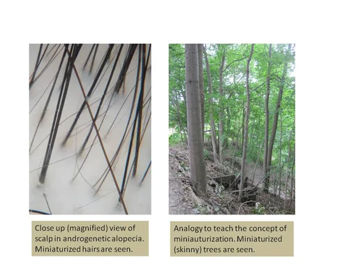 Follicular "miniaturization" in Androgenetic alopecia — Donovan Hair Clinic