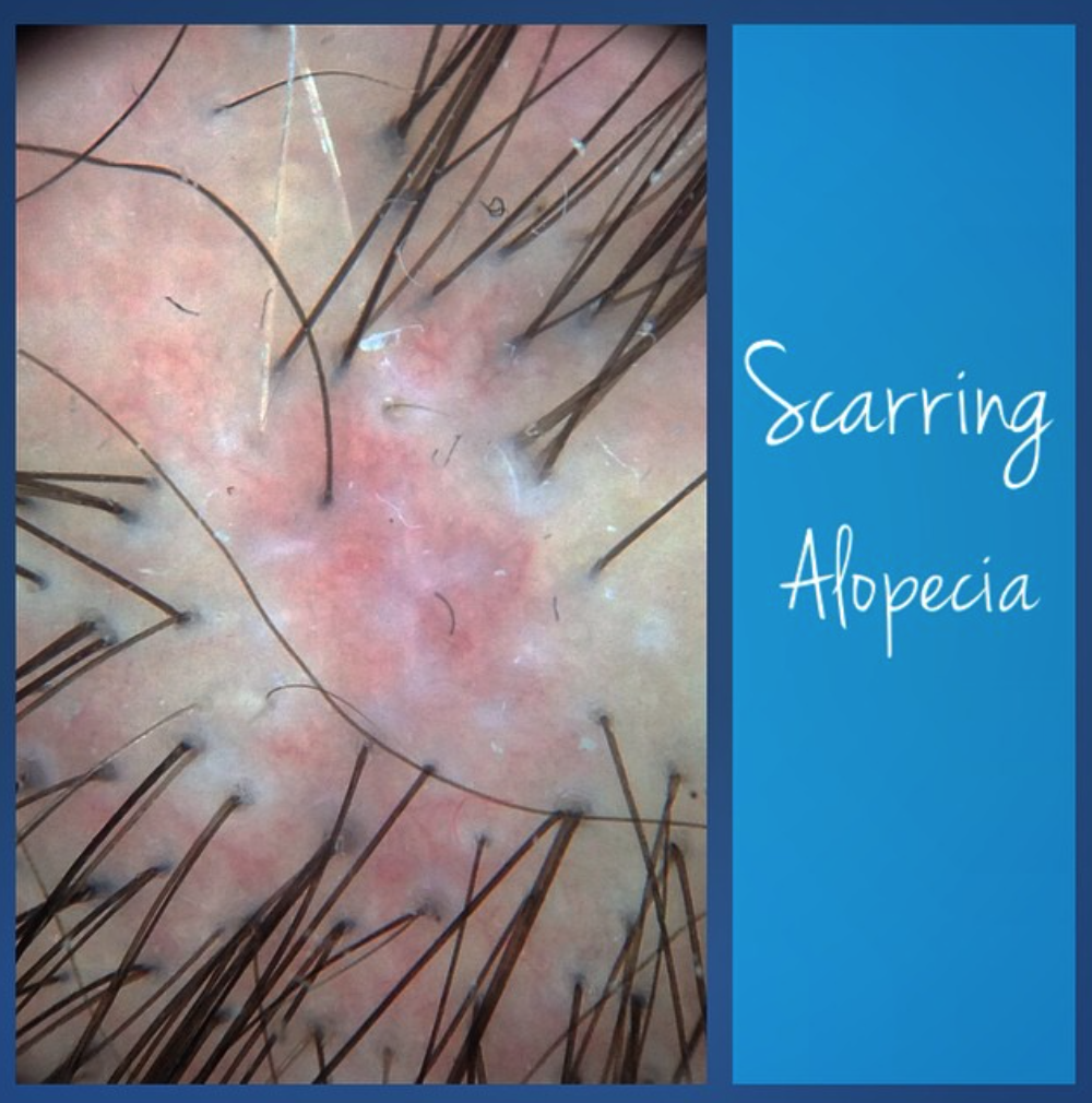 Hair transplants and scarring alopecia — Donovan Hair Clinic