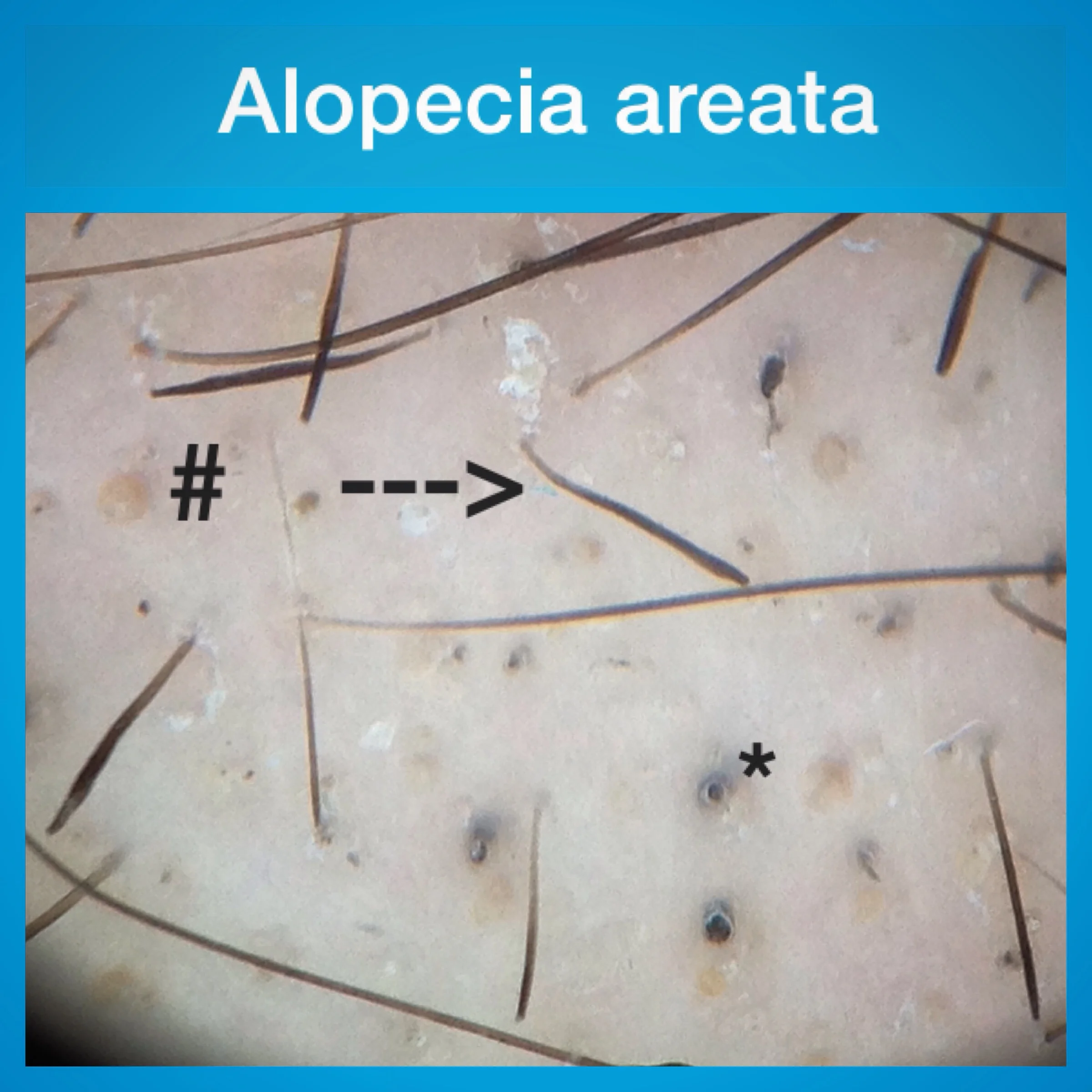 What are the features "up close" of alopecia areata? — Donovan Hair Clinic