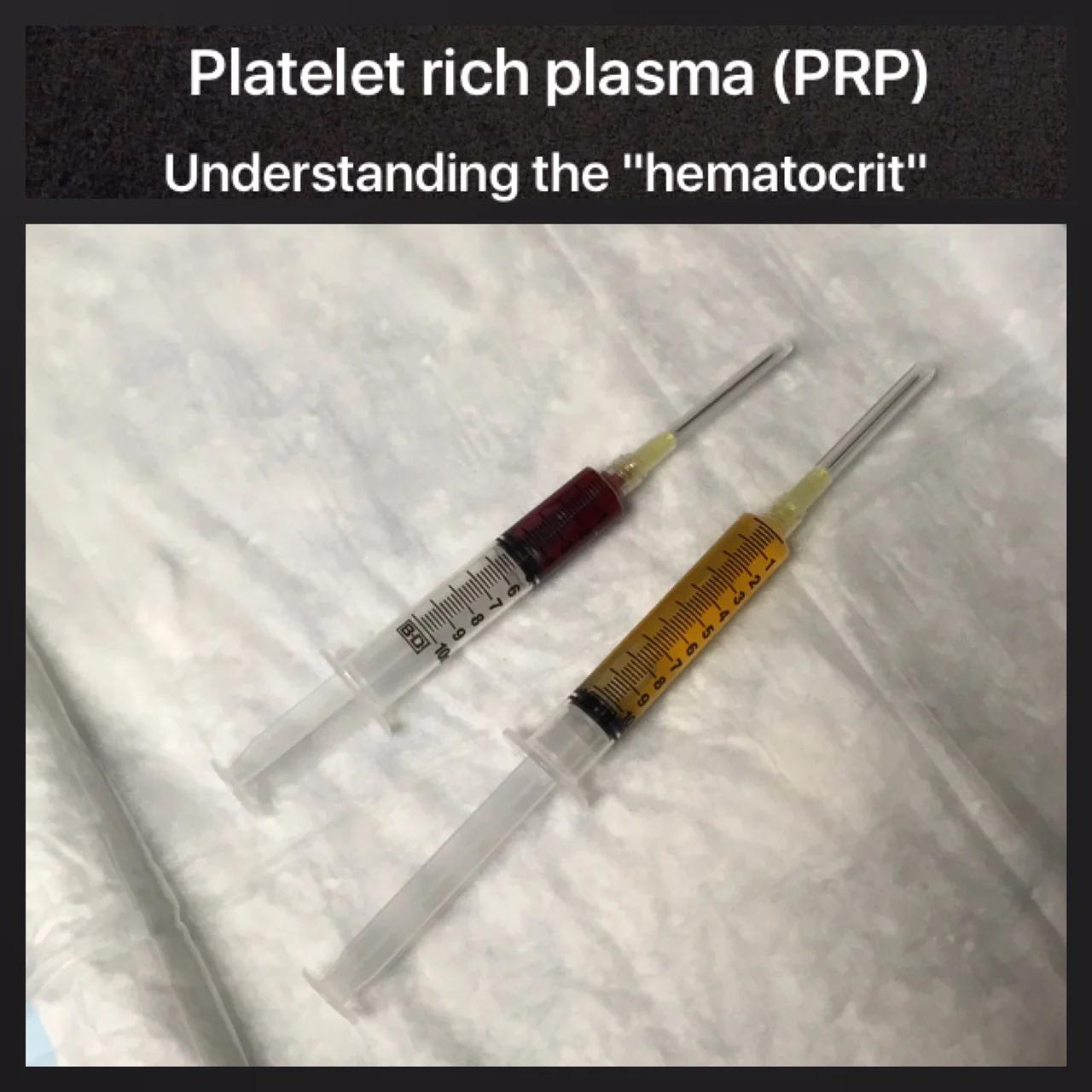 Machine settings for Platelet rich plasma: A Look at Hematocrit ...