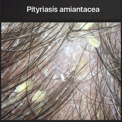 What is "pityriasis amiantacea"? — Donovan Hair Clinic