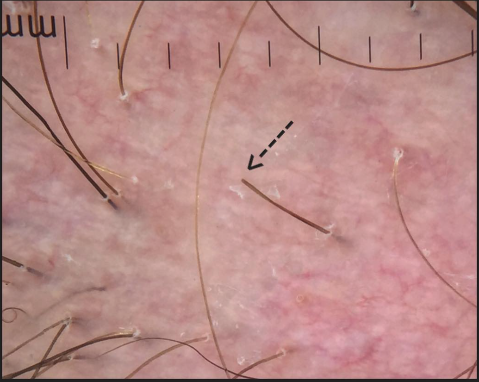Broken hairs in scarring alopecia — Donovan Hair Clinic