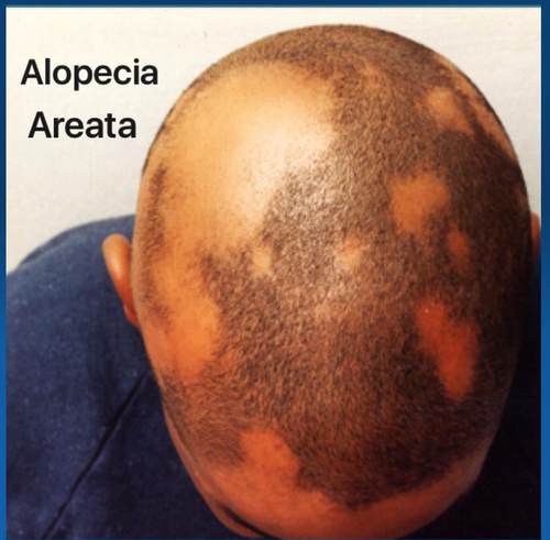 Happy International Alopecia Day — Donovan Hair Clinic