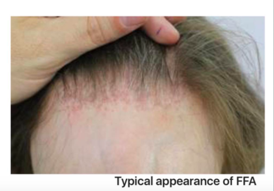 Frontal Fibrosing Alopecia (FFA) — Donovan Hair Clinic
