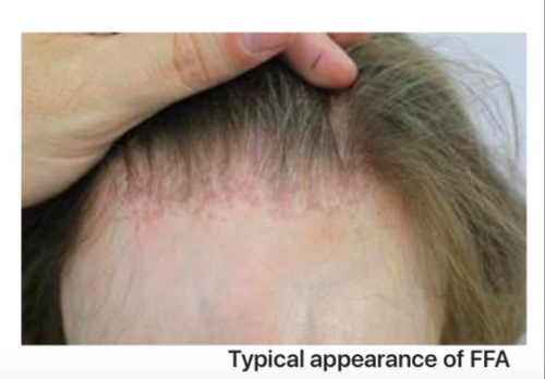 Frontal Fibrosing Alopecia (FFA) — Donovan Hair Clinic