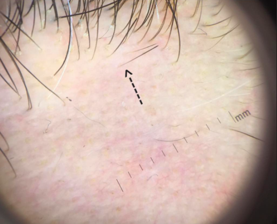 Exclamation mark hairs in Alopecia Areata are located at the periphary ...