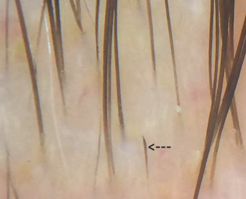 Exclamation mark hairs in Alopecia Areata — Donovan Hair Clinic