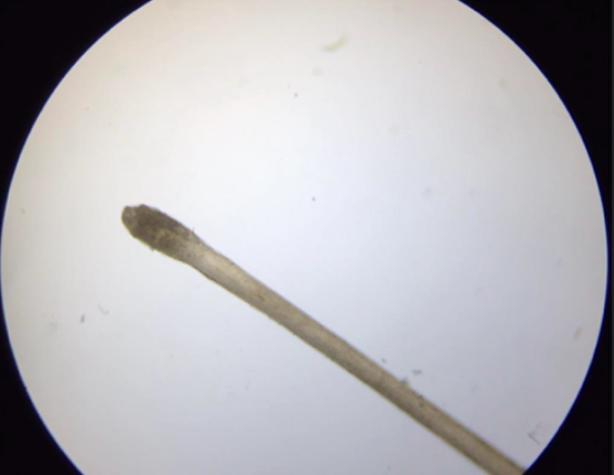 Telogen Hair=Club Hair — Donovan Hair Clinic