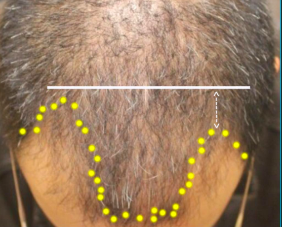 How "perfect" is the balding process — Donovan Hair Clinic