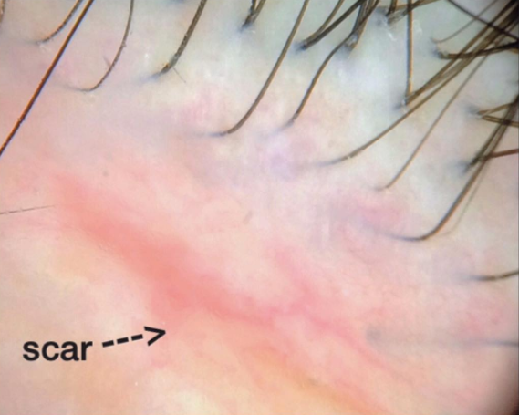 Wounds healing without scars — Donovan Hair Clinic