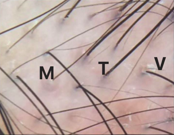 Androgenetic Alopecia — Donovan Hair Clinic