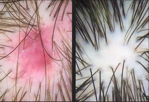 Scalp biopsies lead to a small scar — Donovan Hair Clinic