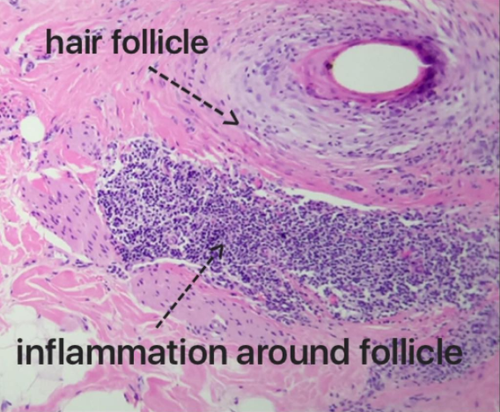 Lichen Planopilaris (LPP) — Donovan Hair Clinic