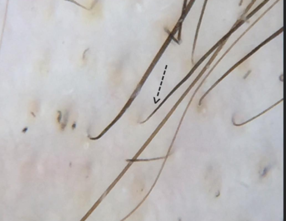 Tapered Hair in AA — Donovan Hair Clinic