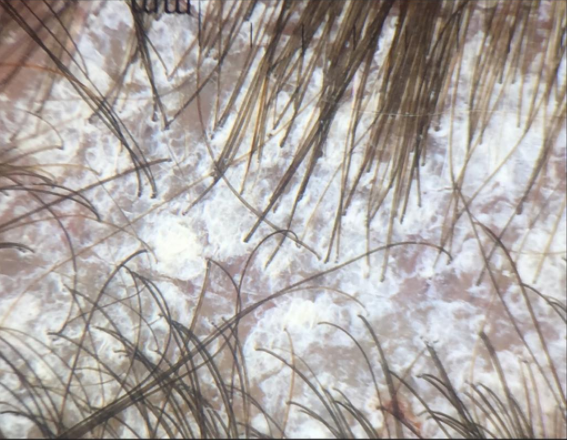 Scalp Psoriasis — Donovan Hair Clinic