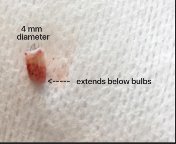Scalp Biopsy — Donovan Hair Clinic