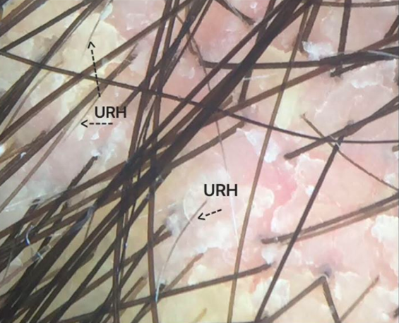 Is It possible for seb derm to cause hair loss? — Donovan Hair Clinic