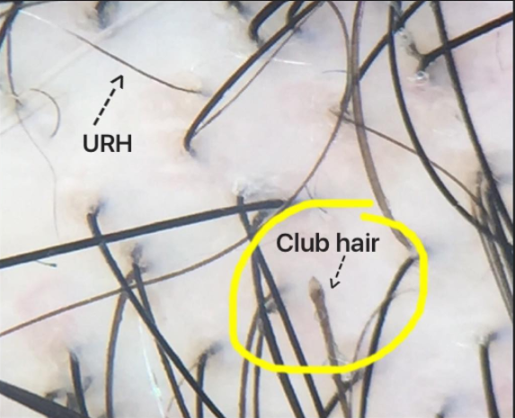 Hair Shedding and the "Exogen" Phase — Donovan Hair Clinic