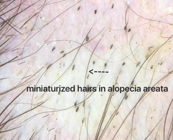 Who said miniaturization only happens in AGA? — Donovan Hair Clinic
