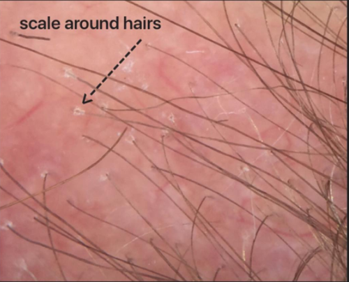 Scalp Frontal Fibrosing Alopecia (FFA) — Donovan Hair Clinic