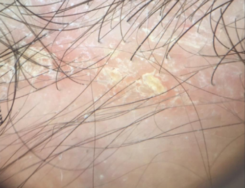 Psoriasis + Seborrheic Dermatitis — Donovan Hair Clinic