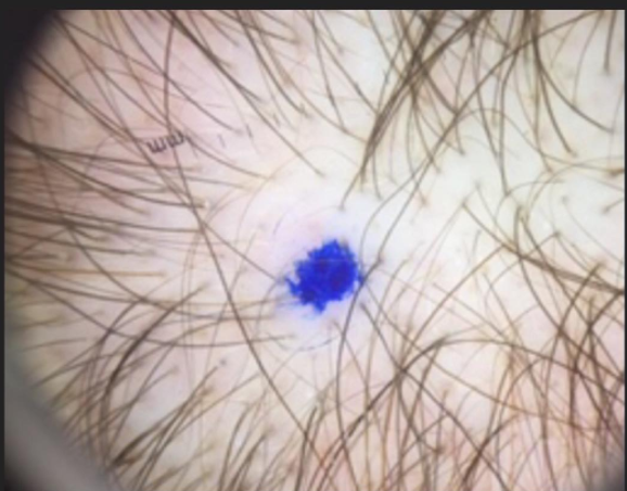 Scalp Biopsies — Donovan Hair Clinic