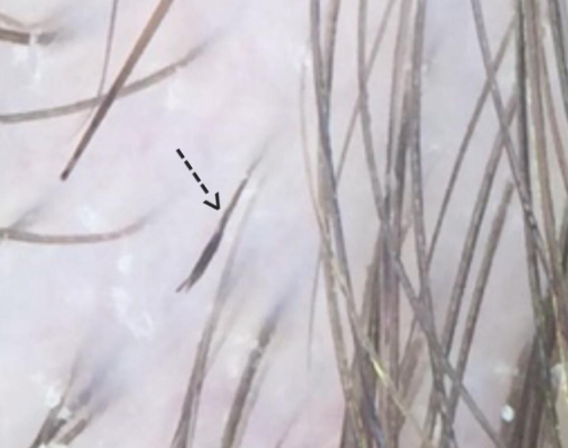 Trichotillomania — Donovan Hair Clinic