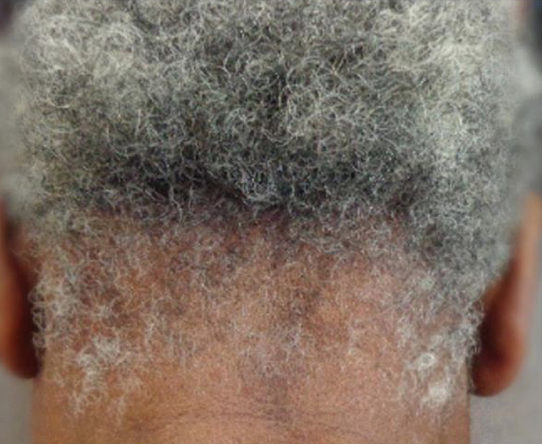 Hair Loss At The Nape Of The Neck What Are The Main Causes — Donovan