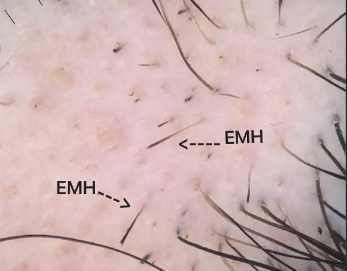 Tapered and Exclamation Mark Hairs in Alopecia Areata — Donovan Hair Clinic