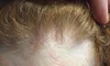 Do I have Frontal Fibrosing Alopecia? — Donovan Hair Clinic