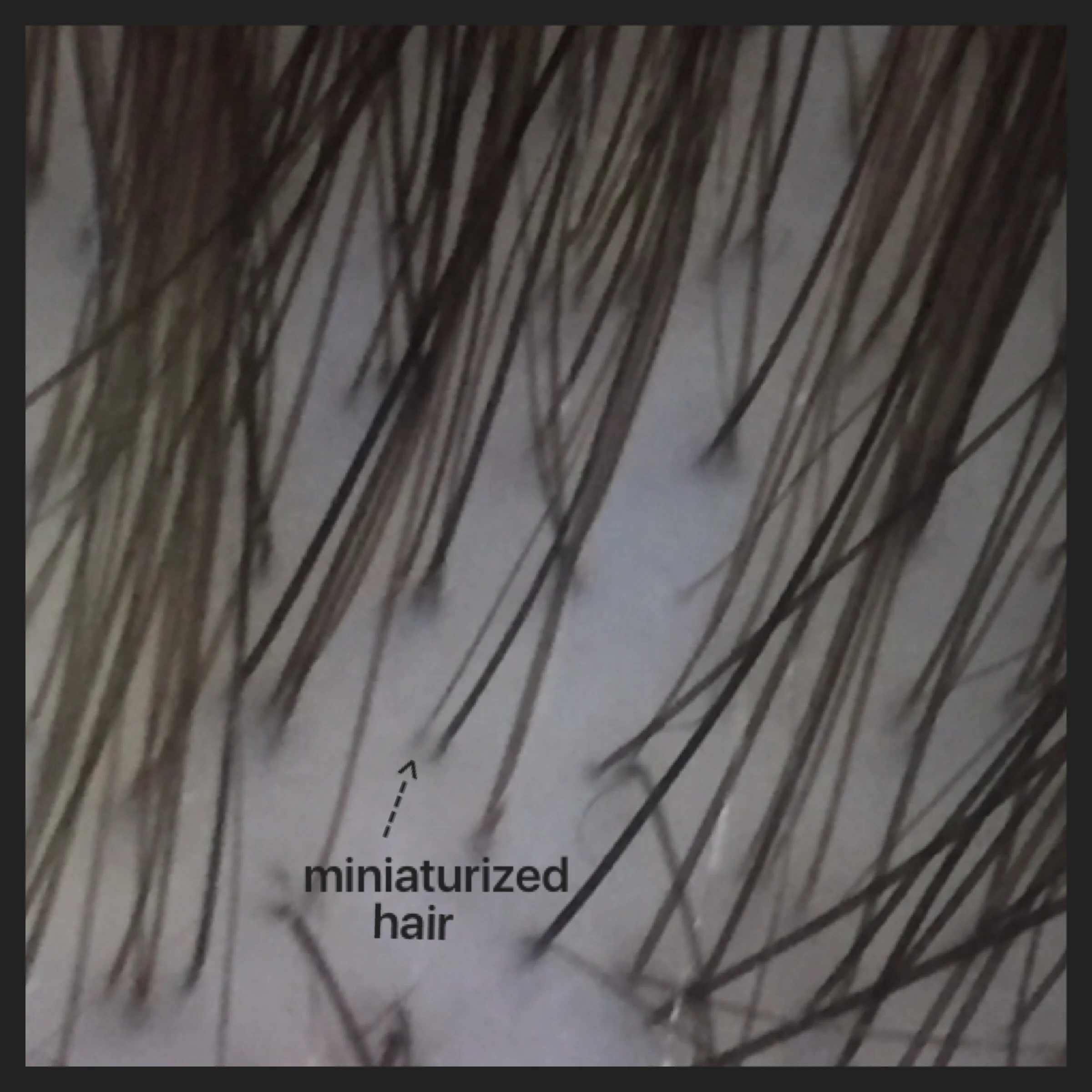 "Miniaturization" and "Anisotrichosis" in Androgenetic Alopecia ...