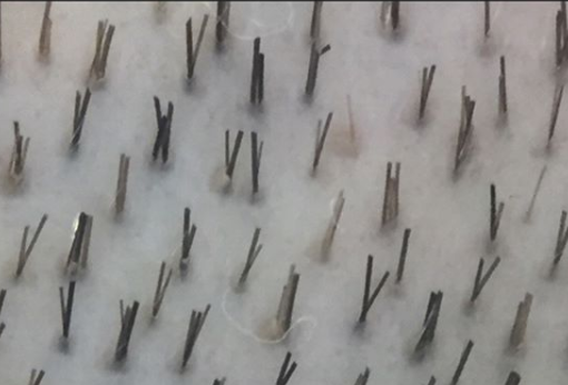 HOW ARE HAIR FOLLICLES ARRANGED? — Donovan Hair Clinic