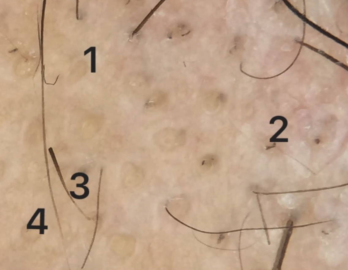 Alopecia areata: Up close — Donovan Hair Clinic