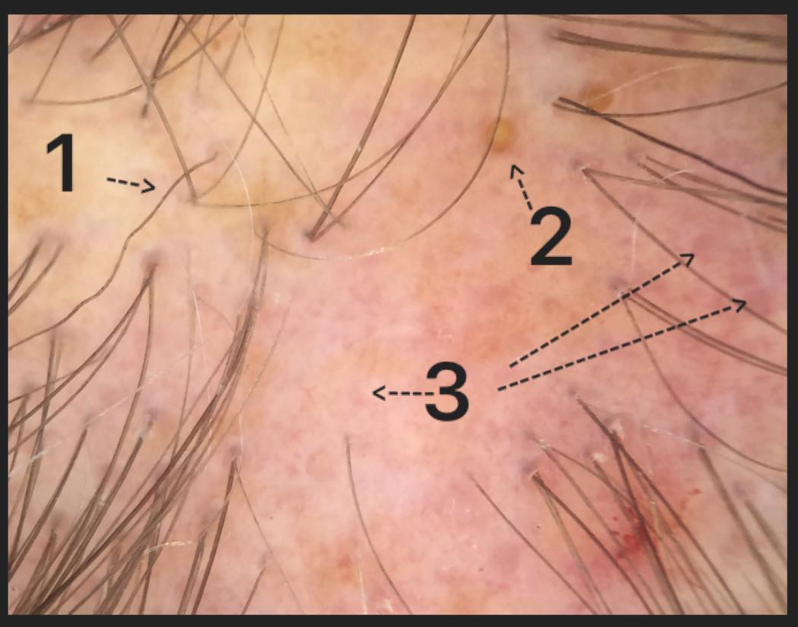 Discoid lupus ("DLE") — Donovan Hair Clinic