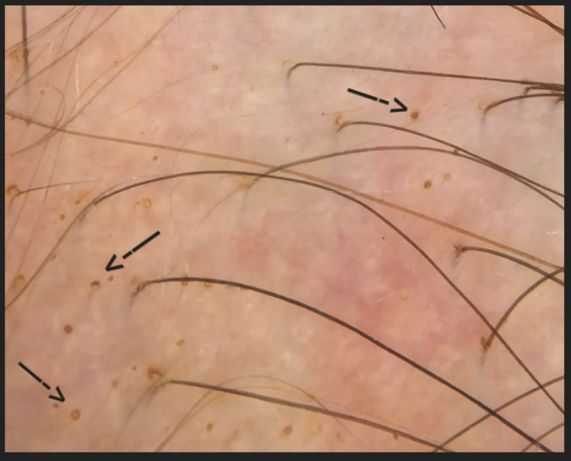 Trichoscopy of Hair Dyes — Donovan Hair Clinic