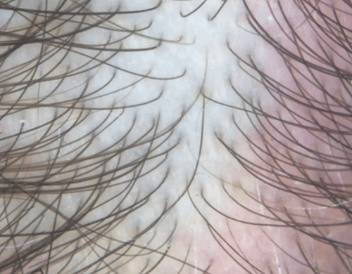 Female Pattern Hair Loss — Donovan Hair Clinic