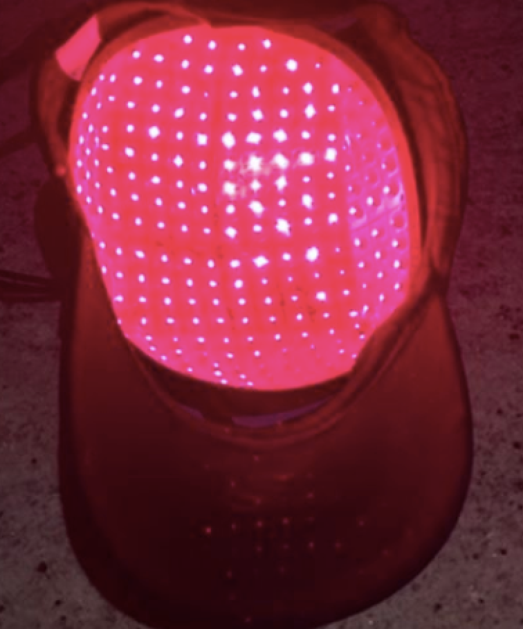 Low level laser for Lichen Planopilaris: Early Data — Donovan Hair Clinic