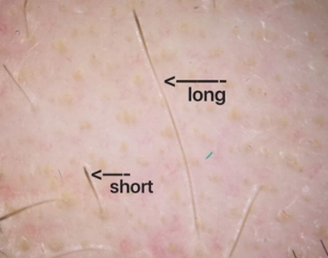 EXCLAMATION MARK HAIRS IN ALOPECIA AREATA — Donovan Hair Clinic