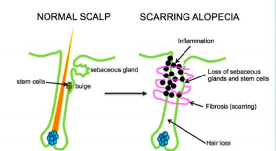 What is scarring alopecia? — Donovan Hair Clinic