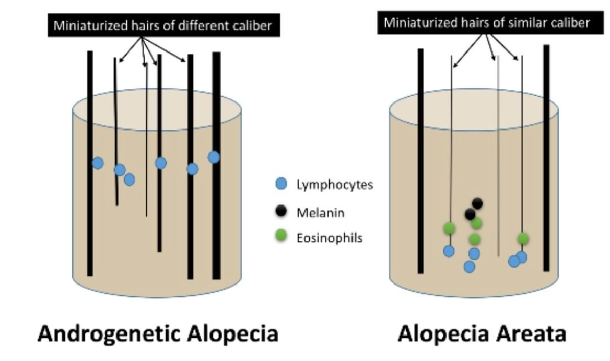 Miniaturization in Alopecia Areata vs Androgenetic Alopecia — Donovan ...