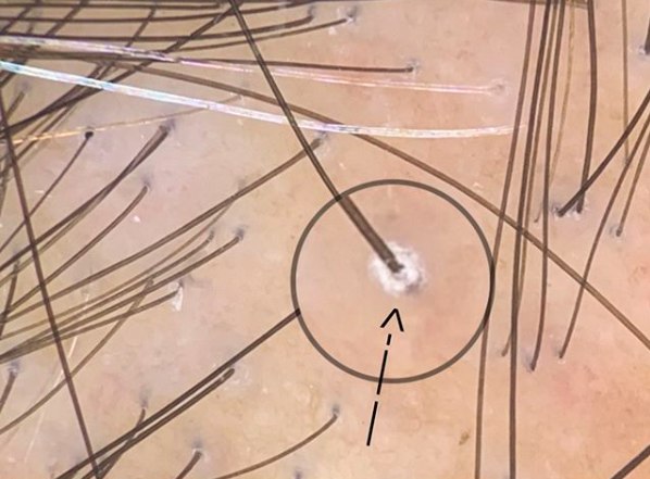 Perifollicular scale in Lichen Planopilaris (LPP): Close Association ...